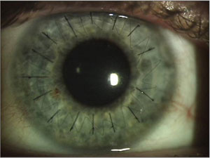 La greffe de cornée | Le Guide De La Vue