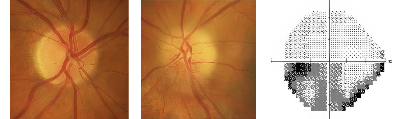 Impact de traitements pour pathologies générales sur la santé des yeux ...