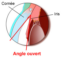 Glaucome - Comprendre le glaucome