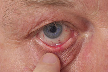 L'orgelet - Symptômes, causes et traitement de l'orgelet