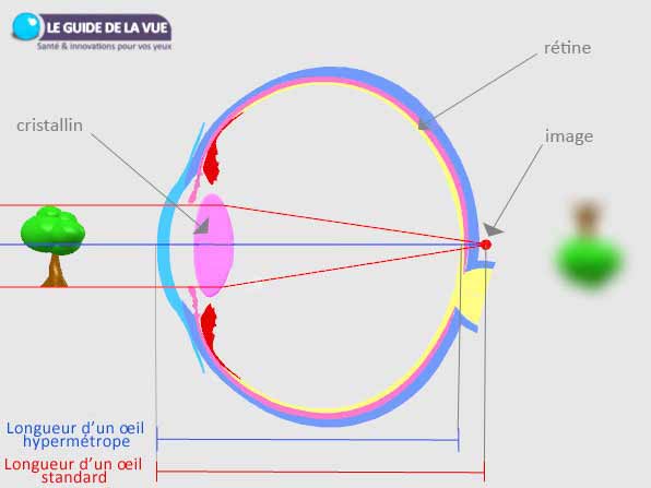 Hypermétrope : mieux comprendre l'hypermétropie